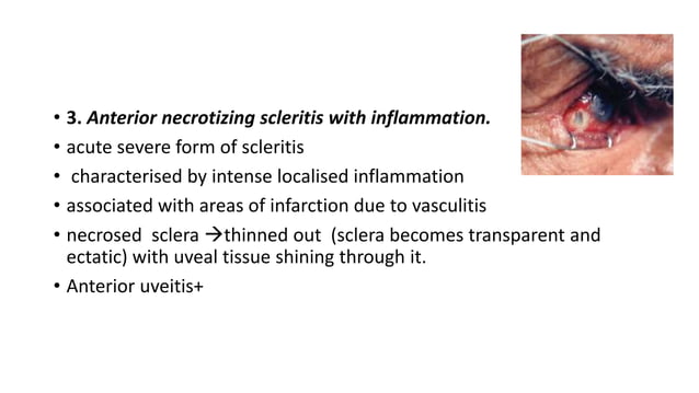 Diseases of sclera | PDF | Eye and Vision Conditions | Diseases and ...