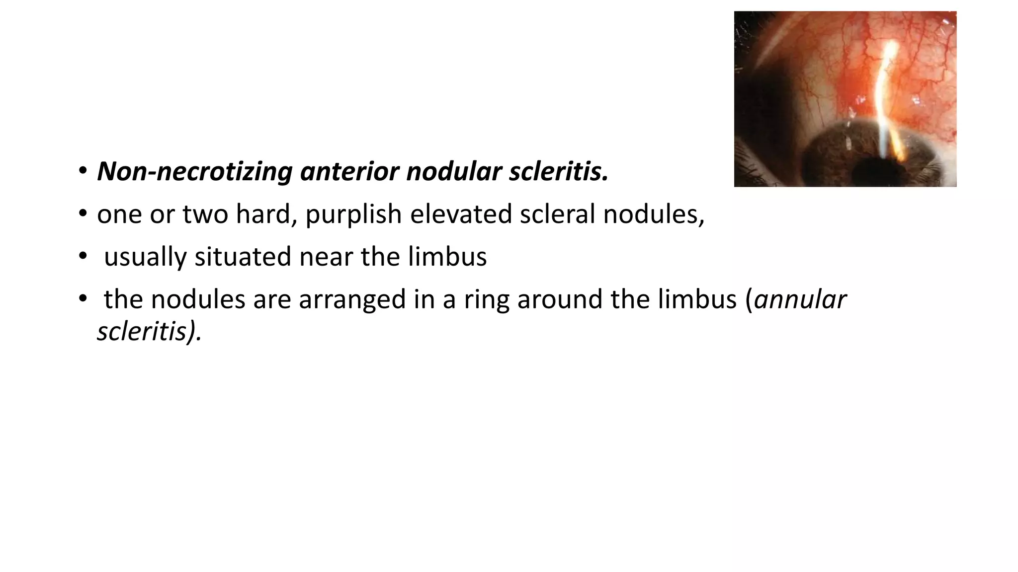 Diseases of sclera ppt ophthalmology | PPTX
