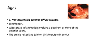 Diseases of sclera ppt ophthalmology | PPTX