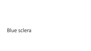 Diseases of sclera ppt ophthalmology | PPTX