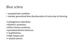 Diseases of sclera ppt ophthalmology | PPTX