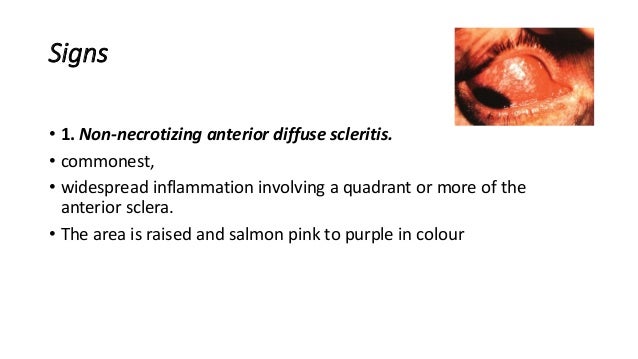 Diseases of sclera ppt ophthalmology