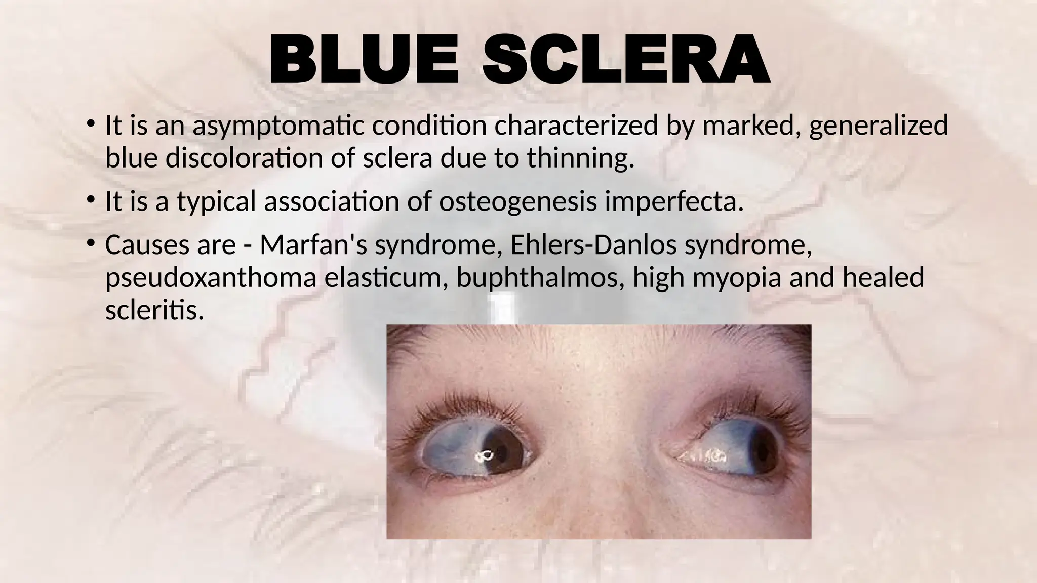 DISEASES OF SCLERA, DISEASES OF SCLERApptx | PPTX