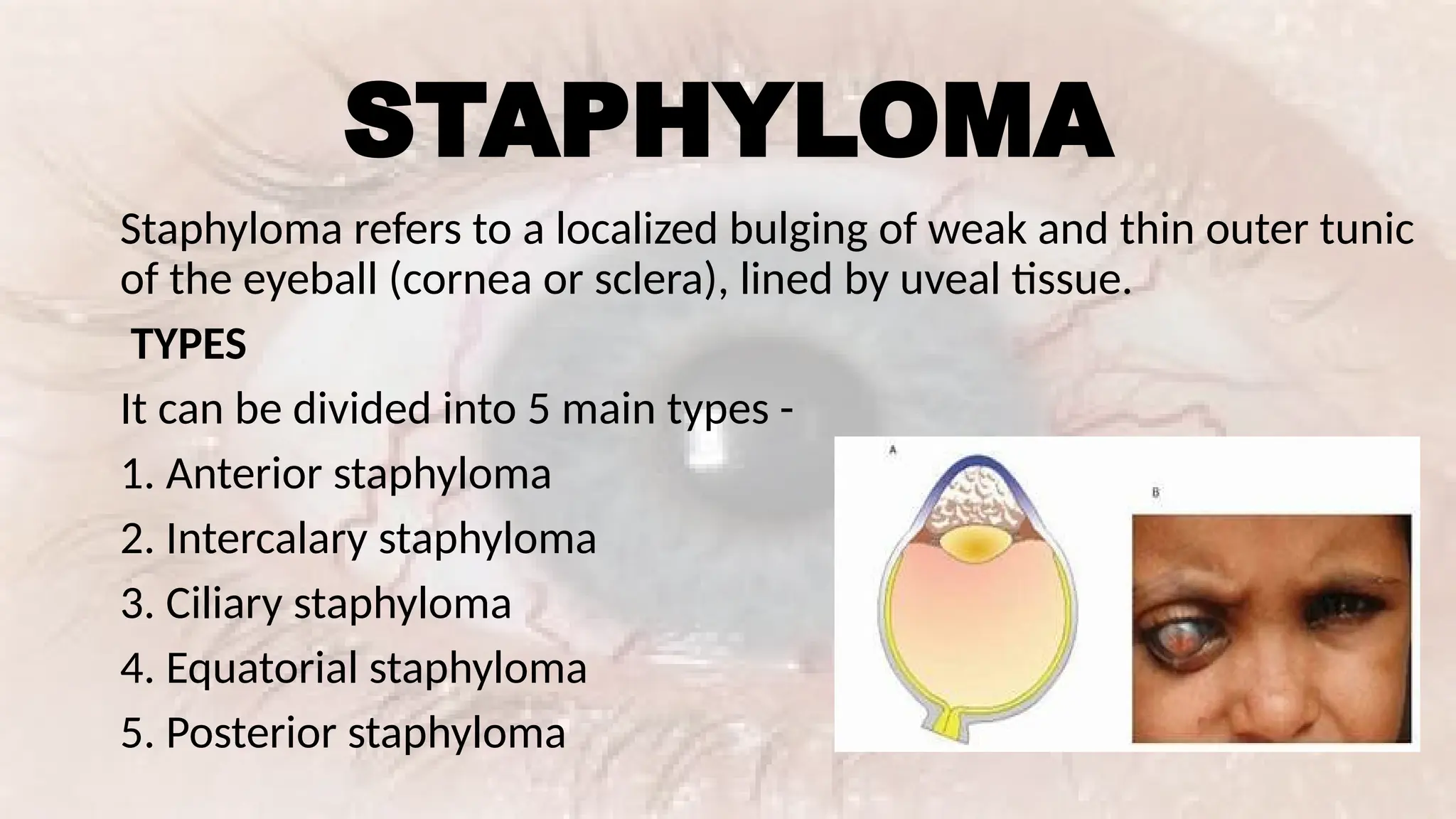 DISEASES OF SCLERA, DISEASES OF SCLERApptx | PPTX