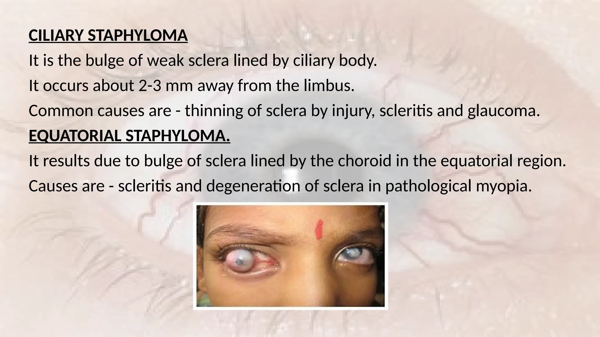 DISEASES OF SCLERA, DISEASES OF SCLERApptx | PPTX