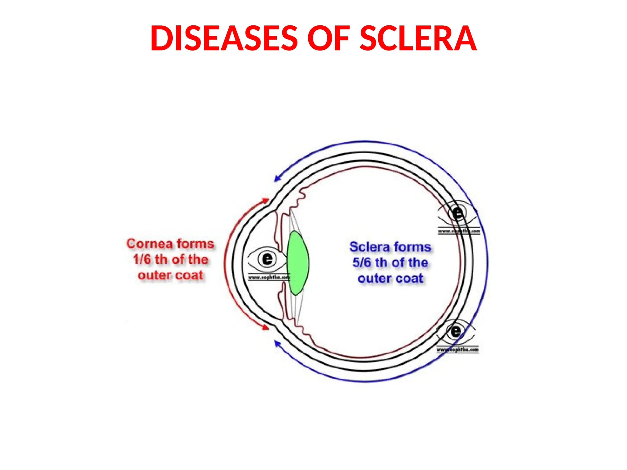Diseases of sclera.ppt scleritis is an inflammatory disease | PPT