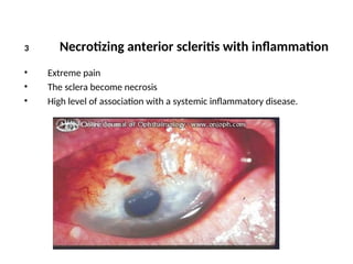 Diseases of sclera.ppt scleritis is an inflammatory disease | PPT