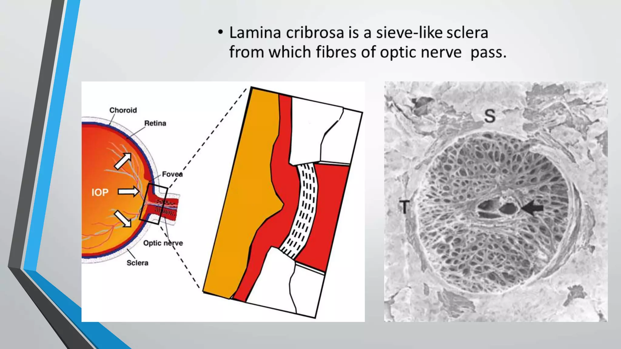 Diseases of sclera | PPTX