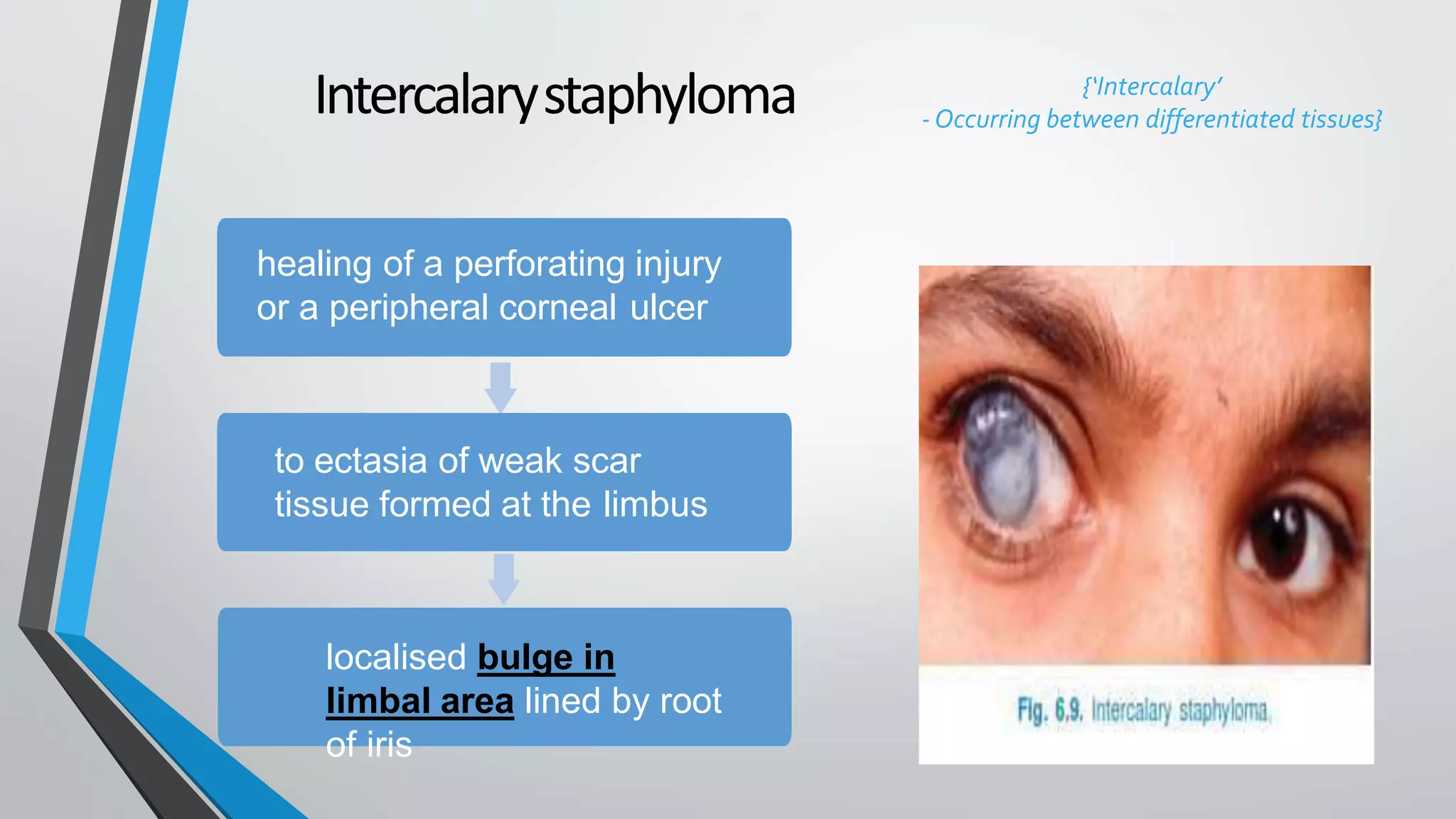 Diseases of sclera | PPTX