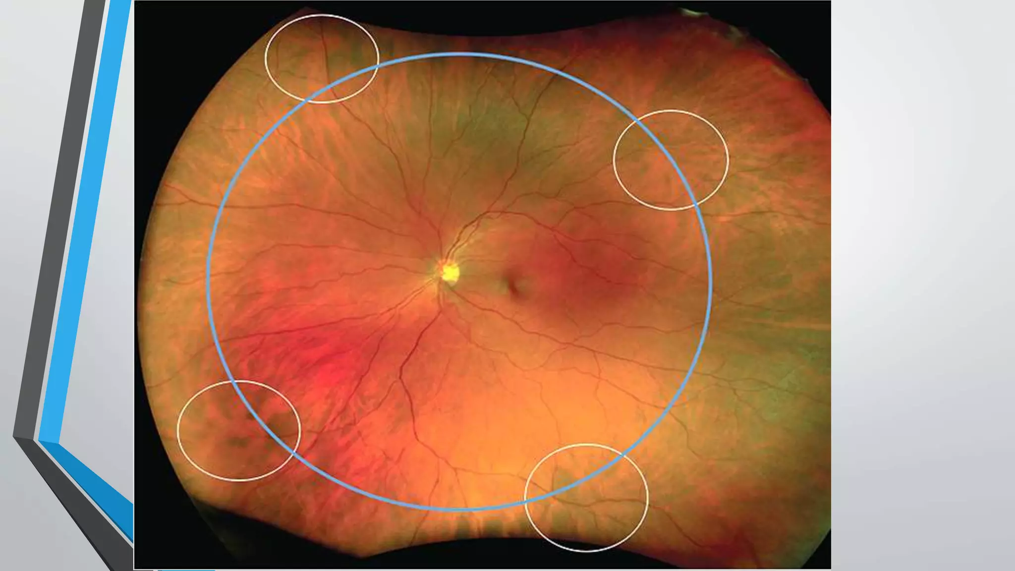 Diseases of sclera | PPTX