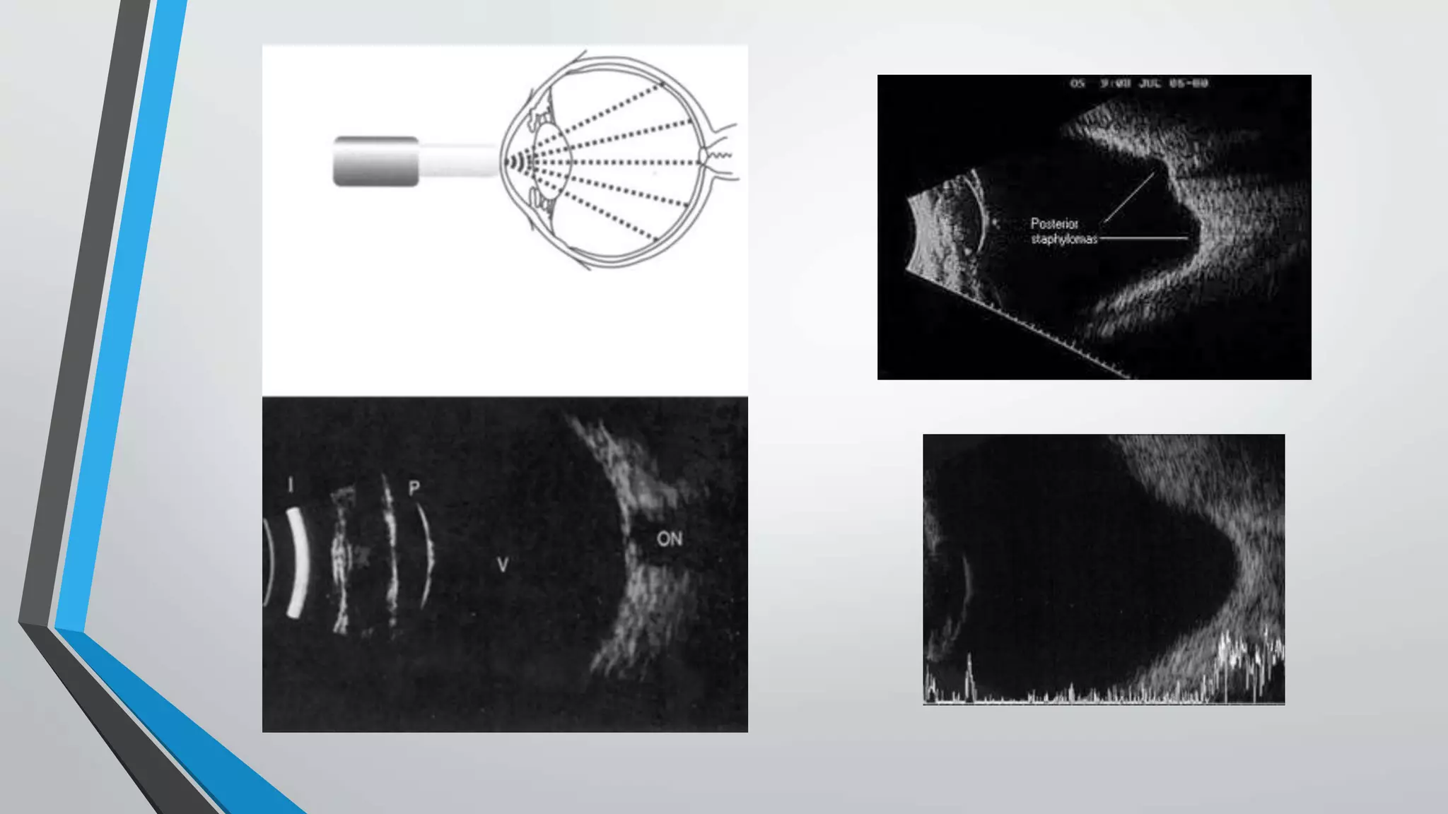 Diseases of sclera | PPTX