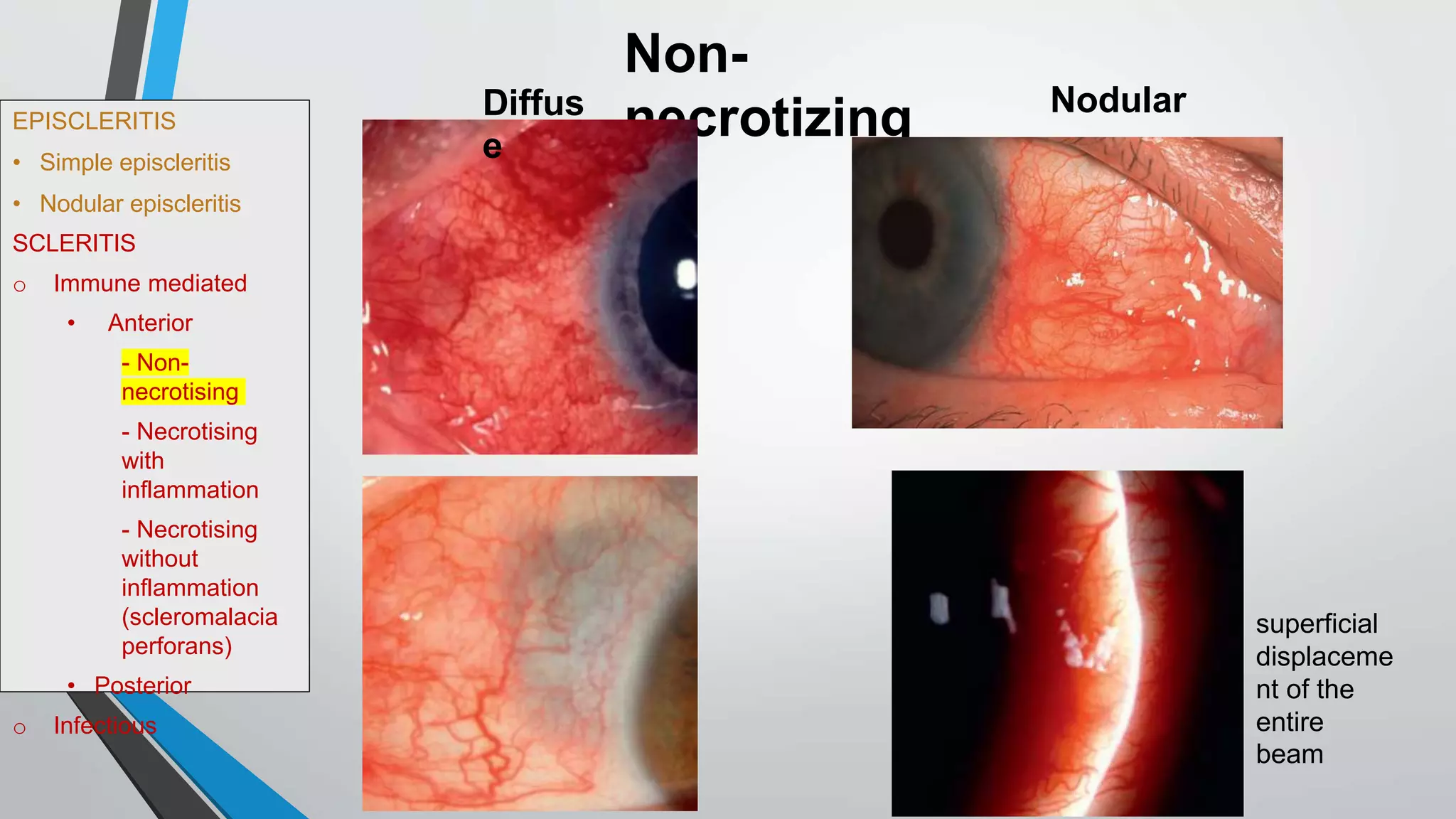 Diseases of sclera | PPTX