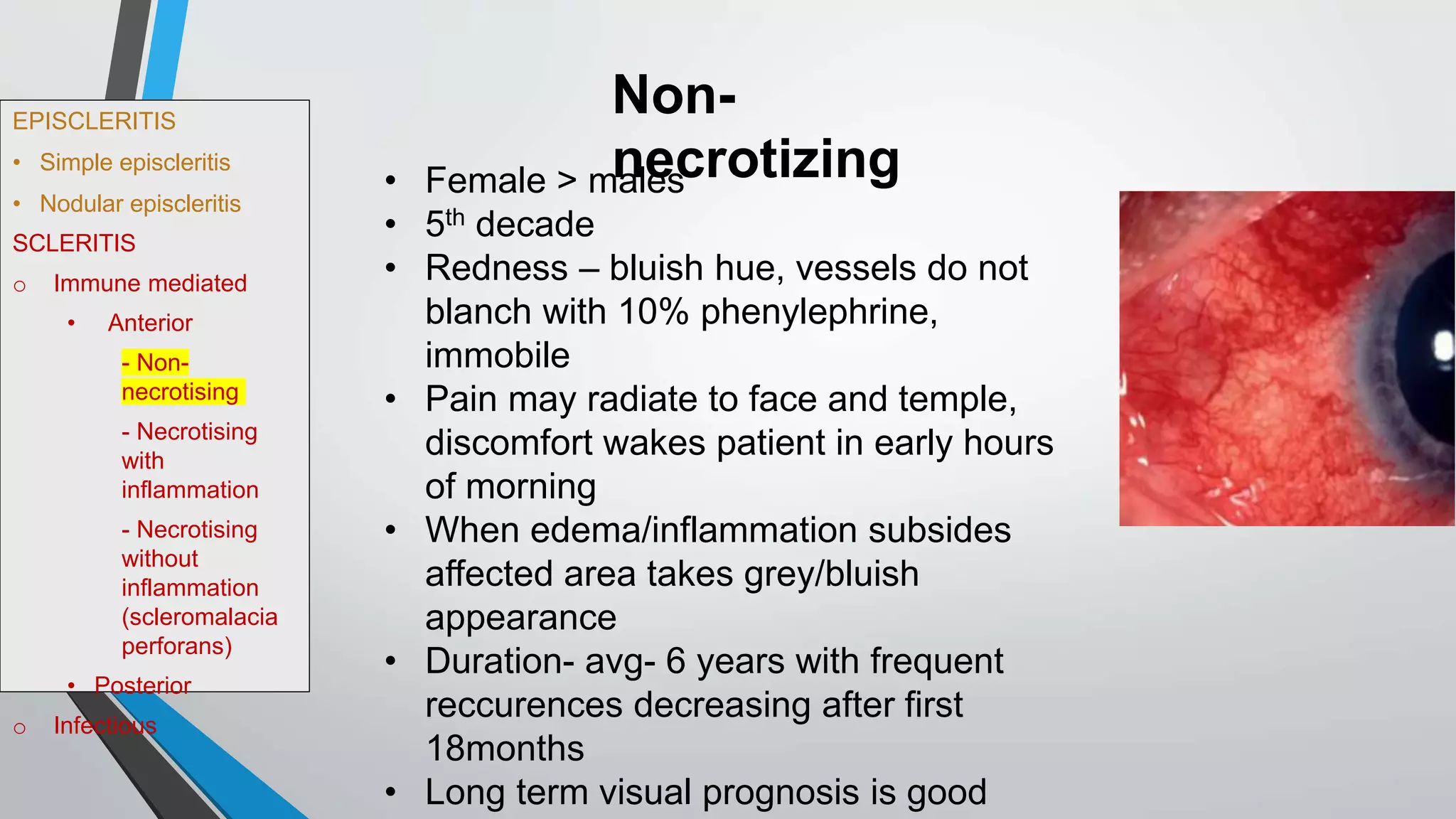 Diseases of sclera | PPTX