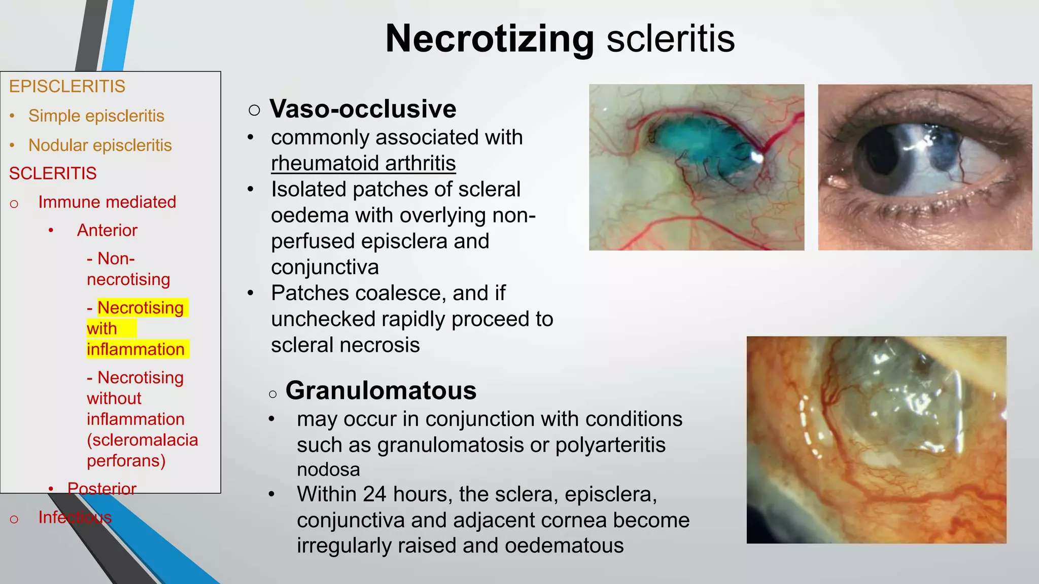 Diseases Of Sclera Ppt