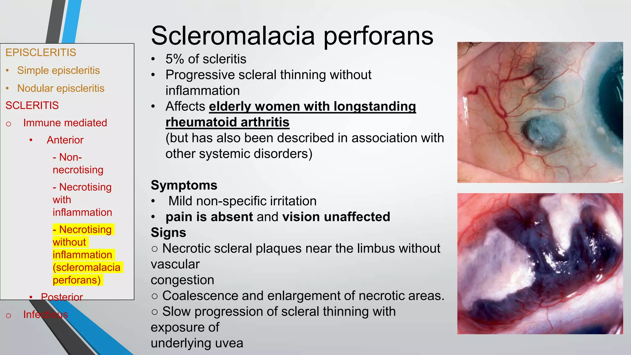 Diseases of sclera | PPTX