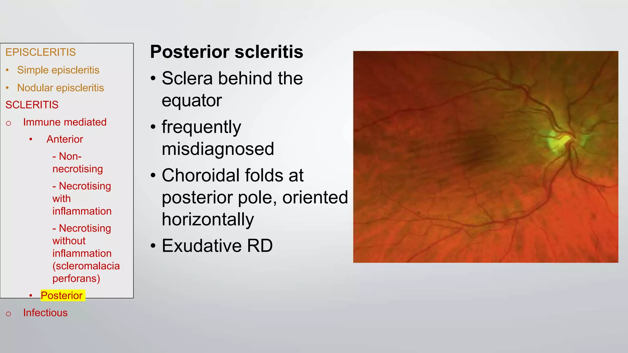 Diseases of sclera | PPTX