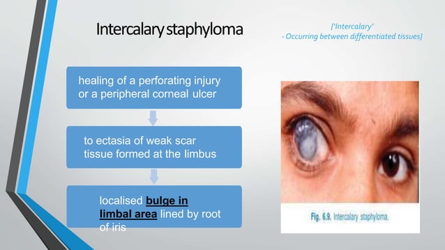 Diseases of sclera | PPTX | Eye and Vision Conditions | Diseases and ...