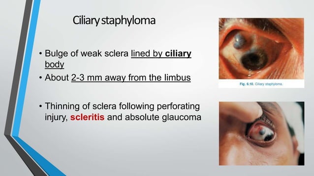 Diseases of sclera | PPTX | Eye and Vision Conditions | Diseases and ...