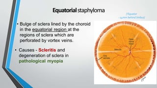 Diseases of sclera | PPTX
