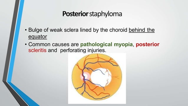 Diseases of sclera | PPTX | Eye and Vision Conditions | Diseases and ...