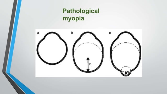 Diseases of sclera | PPTX | Eye and Vision Conditions | Diseases and ...