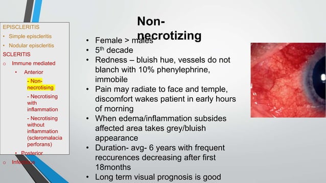 Diseases of sclera | PPTX | Eye and Vision Conditions | Diseases and ...