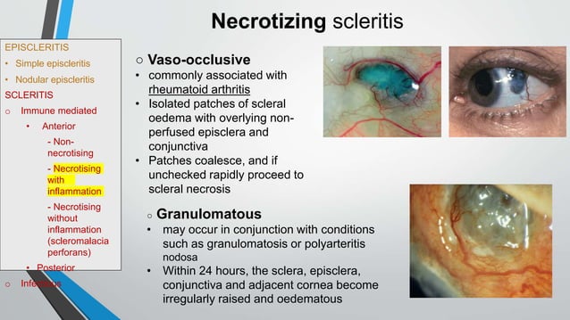 Diseases of sclera | PPTX | Eye and Vision Conditions | Diseases and ...