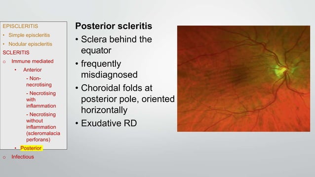 Diseases of sclera | PPTX | Eye and Vision Conditions | Diseases and ...