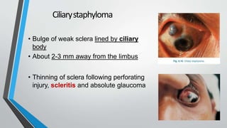 Sclera Disorders
