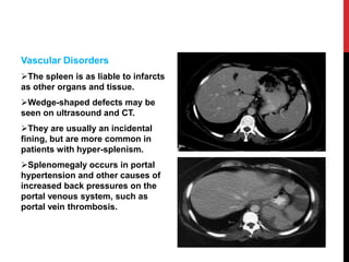 Diseases of spleen | PPTX
