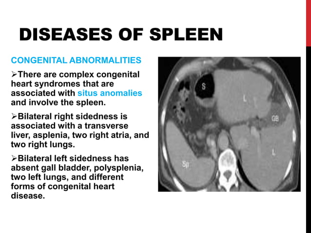 Diseases of spleen | PPT
