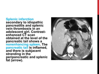 Diseases of spleen | PPTX