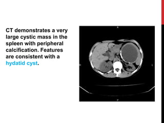 Diseases of spleen | PPTX