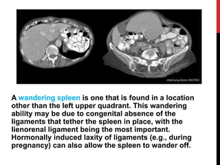 Disorders Of The Spleen