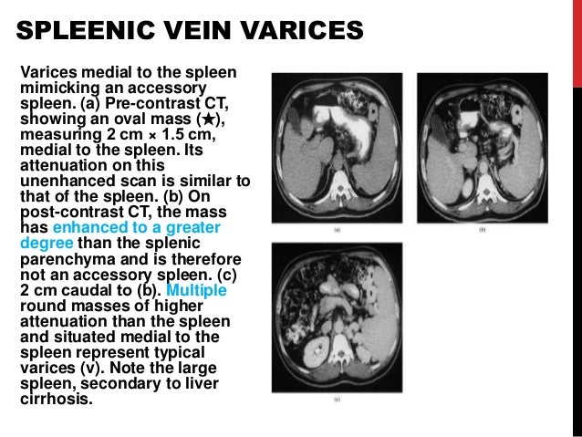 Diseases of spleen