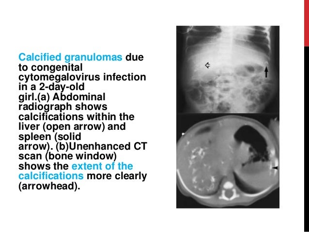 Diseases of spleen