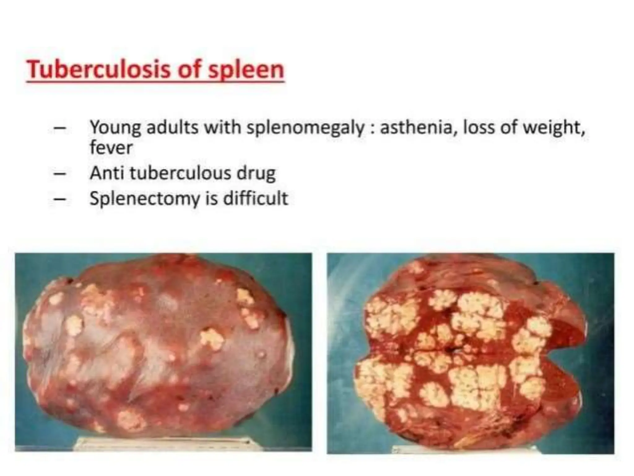 Diseases of Spleen, treatment with surgical treatment | PPTX