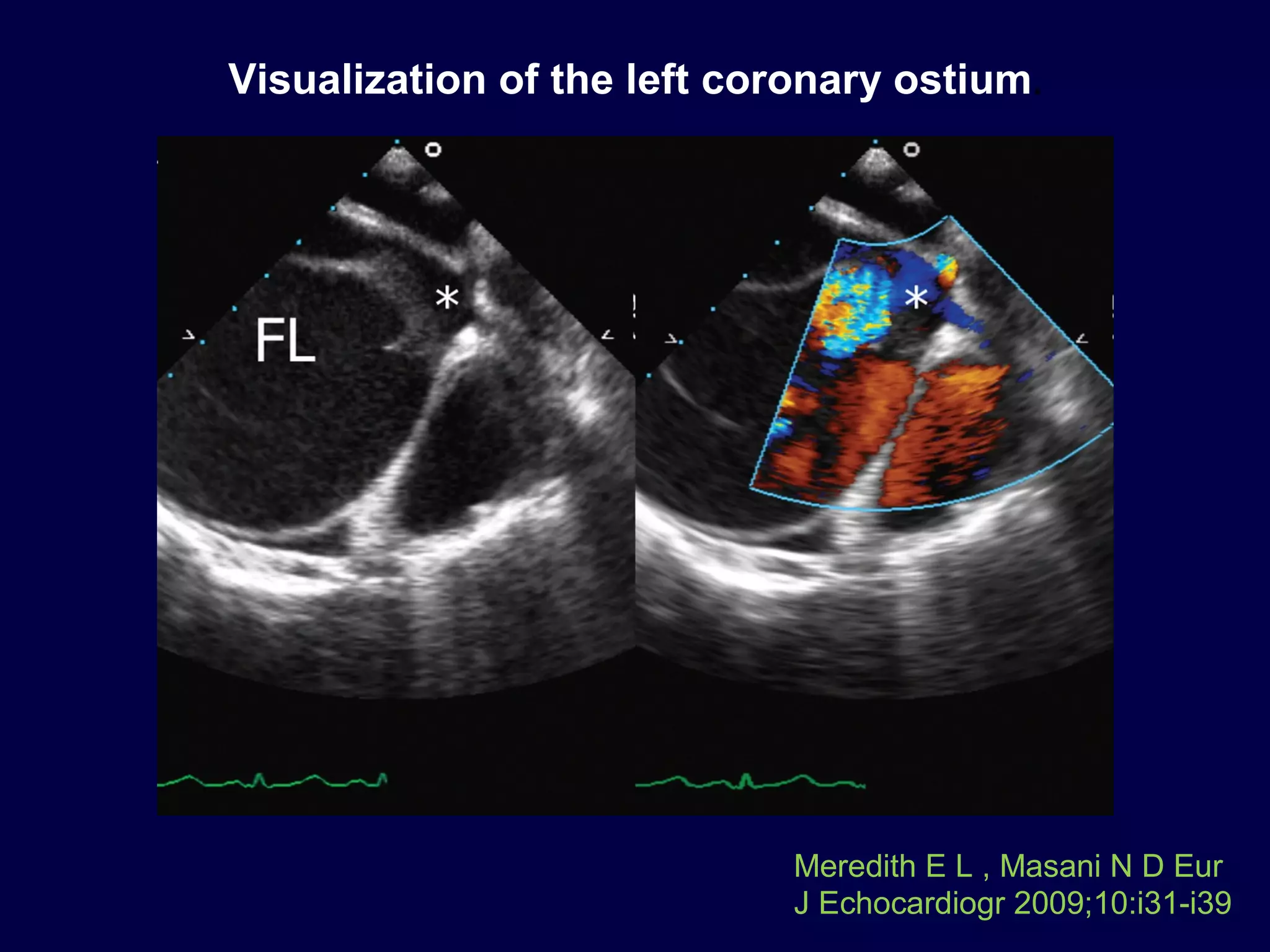 Diseases of the aorta | PPT | Blood Disorders | Diseases and Conditions