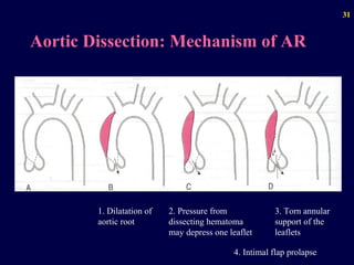 Diseases of the aorta | PPT