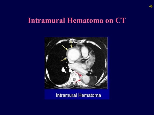 Diseases of the aorta | PPT | Blood Disorders | Diseases and Conditions