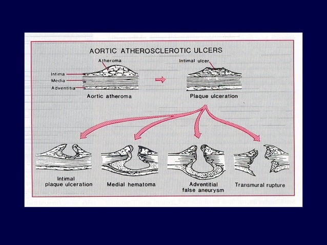 Diseases of the aorta | PPT | Blood Disorders | Diseases and Conditions