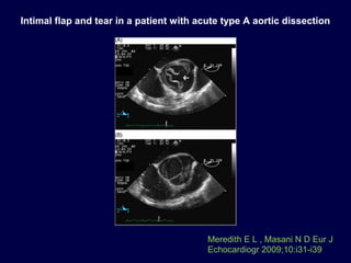Diseases of the aorta | PPT