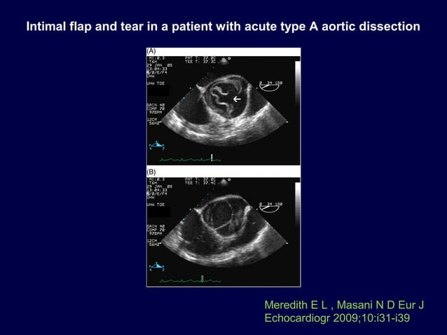 Diseases of the aorta | PPT | Blood Disorders | Diseases and Conditions