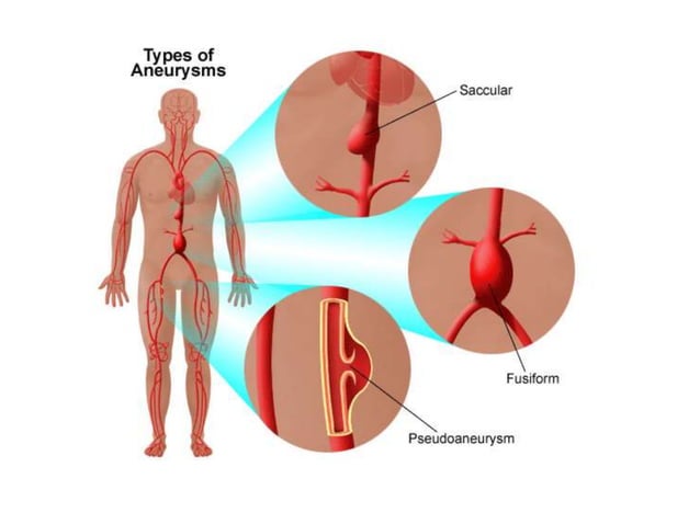 Diseases of the aorta | PPTX | Heart and Cardiovascular Diseases | Diseases and Conditions