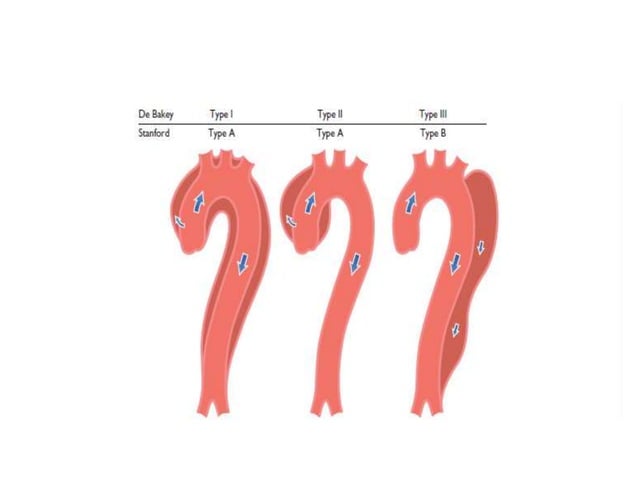 Diseases of the aorta | PPTX | Heart and Cardiovascular Diseases | Diseases and Conditions