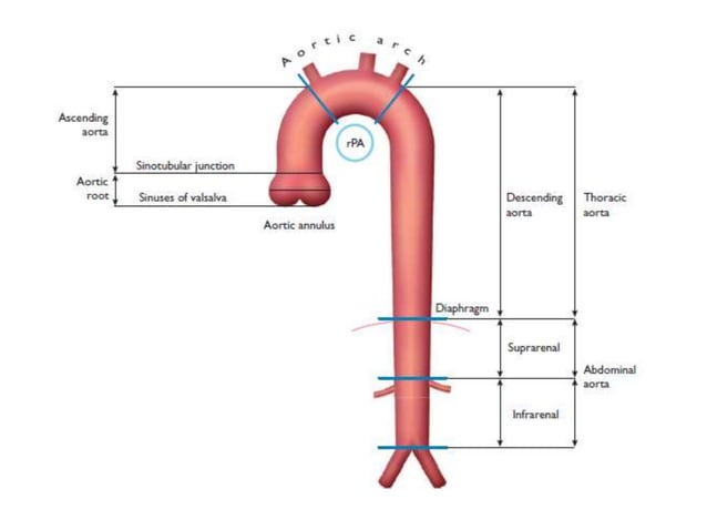 Diseases of the aorta | PPTX | Heart and Cardiovascular Diseases | Diseases and Conditions