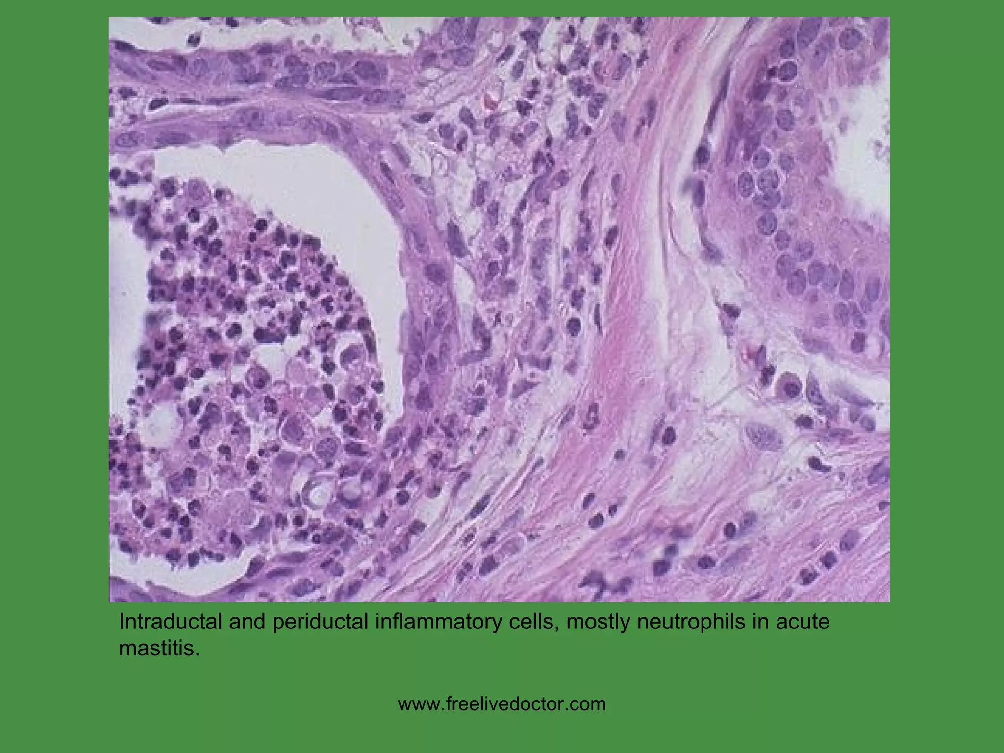 Diseases of the breast | PPT