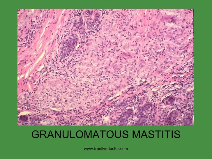 Diseases of the breast