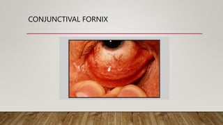 Diseases of the conjuctiva II.pptx