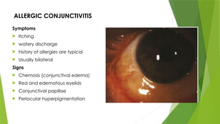 Diseases of the conjunctiva public health (2).pptx